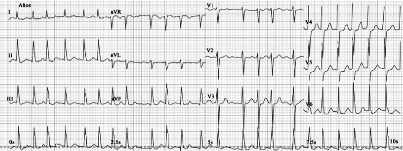 EKG-LA — Comparación de Patrones